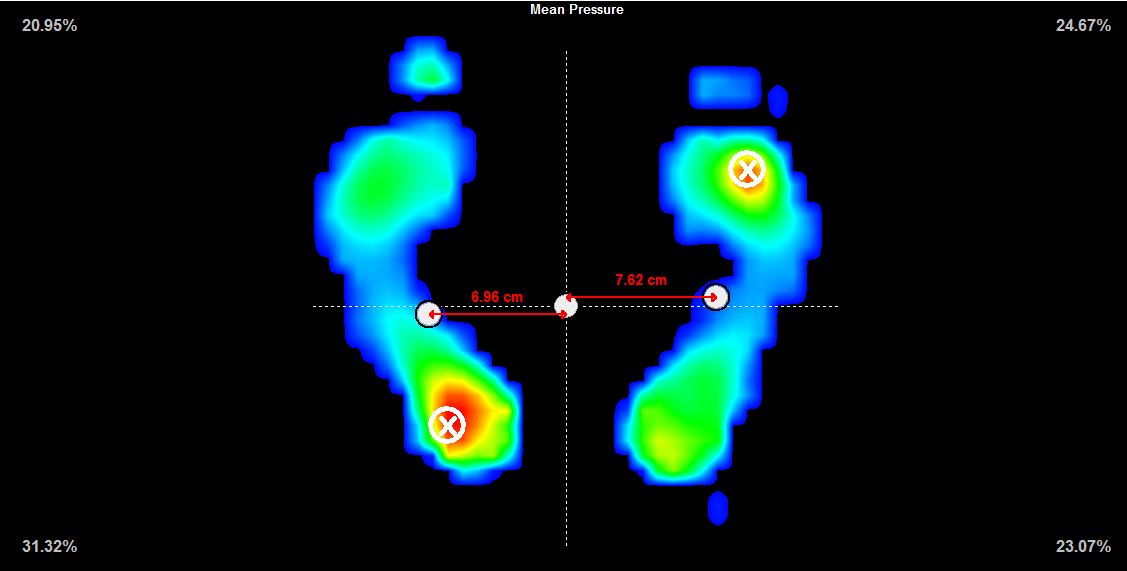 Insole Process – Podiapro : Custom insoles and footwear for pain relief